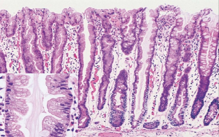 Polypes et polyposes festonnées – FMC-HGE