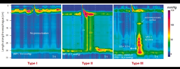 Troubles moteurs oesophagiens : nouvelles classifications, nouveaux traitements – FMC-HGE