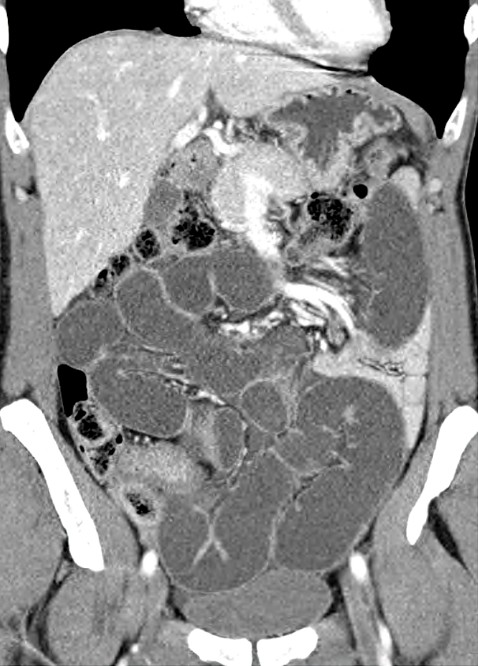 Imagerie en coupe dans la maladie de Crohn hors périnée – FMC-HGE